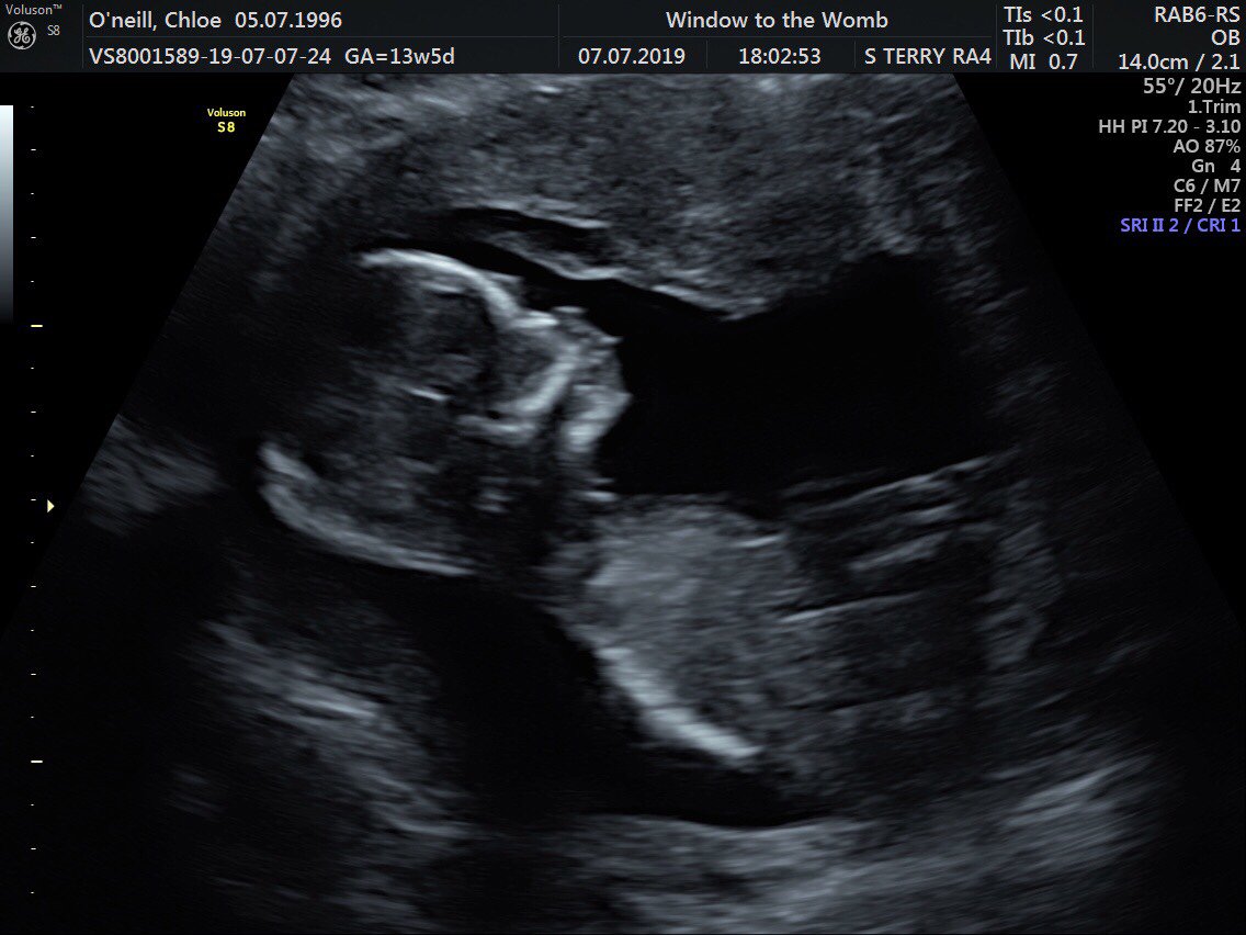 14 week scan photos. Any guesses?