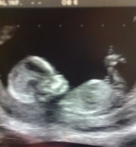 Baby gender guess from 12 week scan
