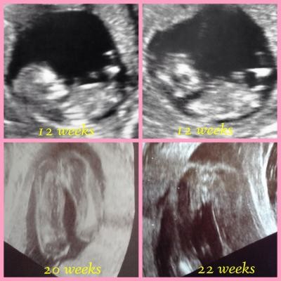 Confirmed genders from 12 week scans for people to compare - Page: 2