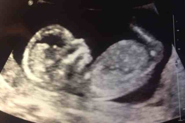 14 week scan, boy or girl?!
