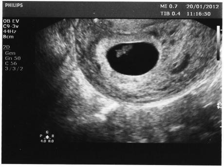 scan at 8 weeks. .will we see much?