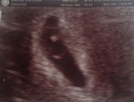 Scan showed an empty sac