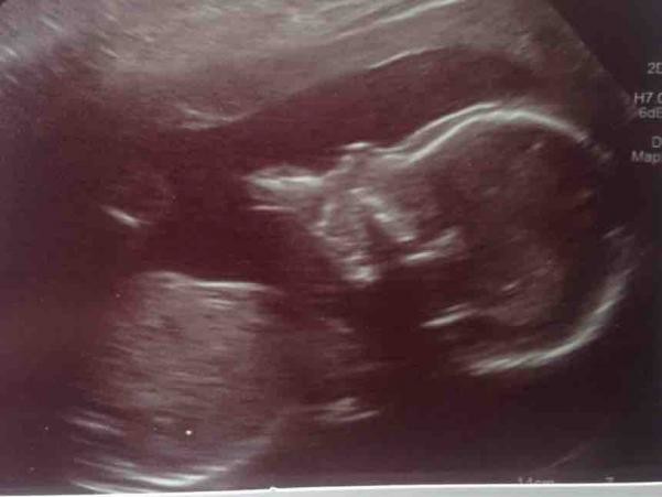 9 week 2 day scan photo...im worried
