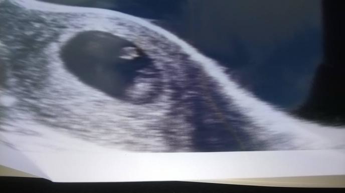 Early Scan high BMI - worried