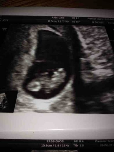 Early Scan high BMI - worried