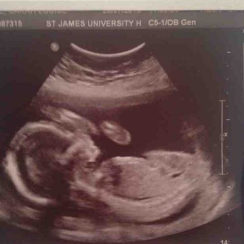 20 week scan gender pics