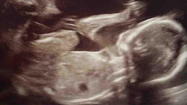 20 week scan gender pics