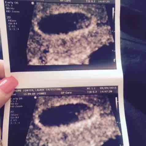 Early pregnancy scan pics?