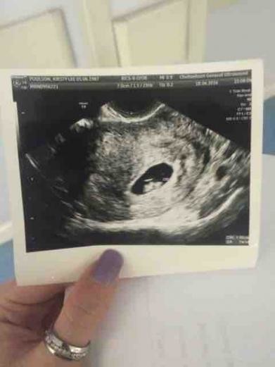 7 week 2 days pregnant
