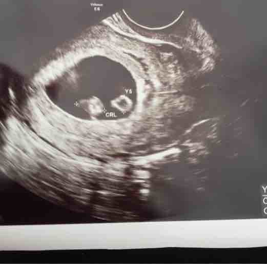 7 week 2 days pregnant