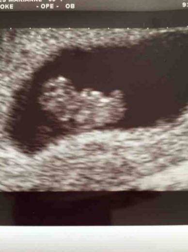9 Weeks 4 Days Scan