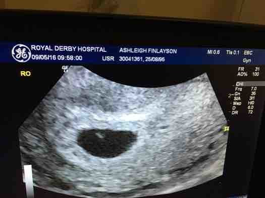 6 week scan, empty sac?