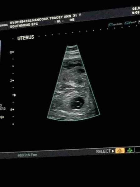 Pregnancy confirmed... With copper coil ? - Page: 3