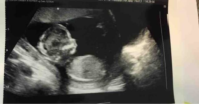 12 week scan/dating scan.