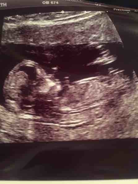 12 week scan/dating scan.