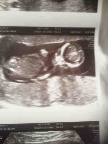 12 week scan/dating scan.