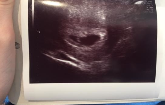 Ramzi theory 6 weeks scan - Page: 3