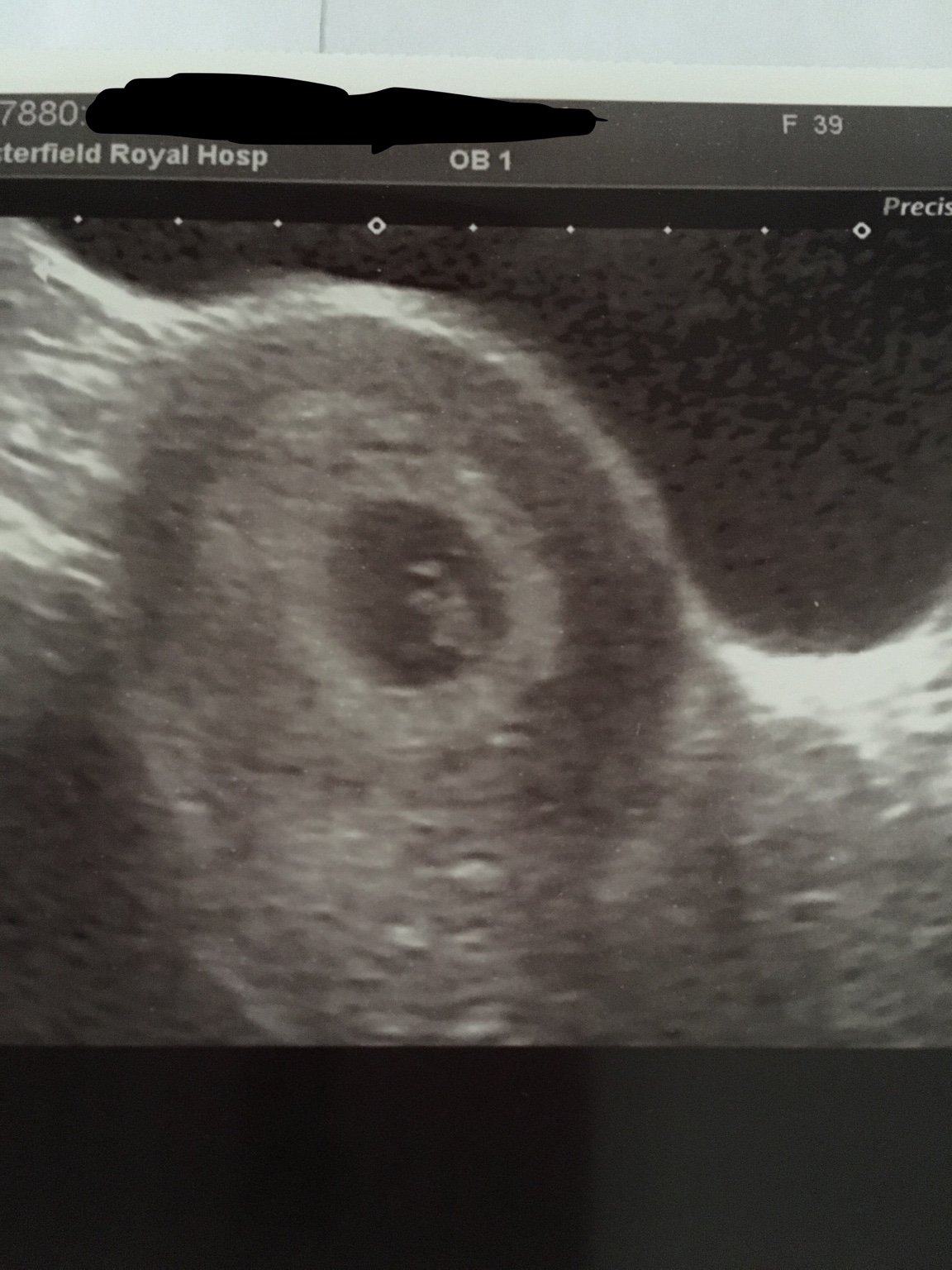 Early Scan 7 weeks today