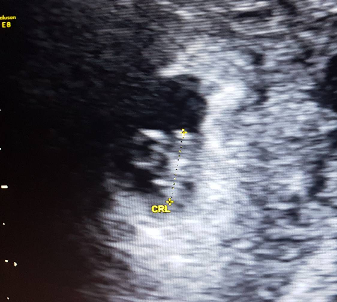 Early Scan 7 weeks today