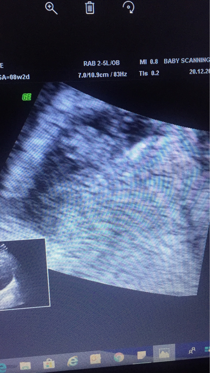9 weeks scan? - Page: 2