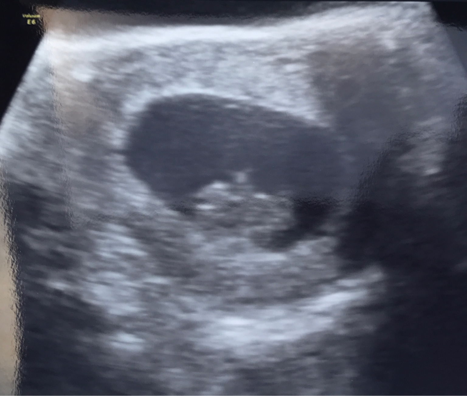 9 weeks scan? - Page: 2