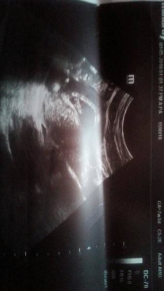 Has anyone had a 7 week scan? What did it look like?