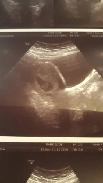 Has anyone had a 7 week scan? What did it look like?