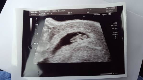 Has anyone had a 7 week scan? What did it look like?