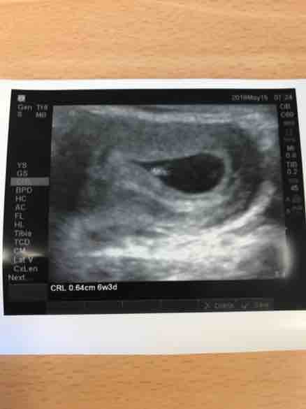 Has anyone had a 7 week scan? What did it look like?
