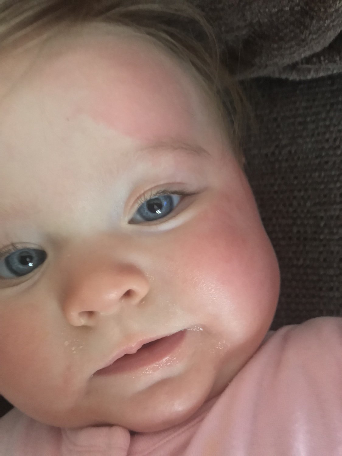 Red Cheeks And Hot To Touch And A Red Patch On Forehead Red Cheeks And Hot To Touch And A Red Patch On Forehead