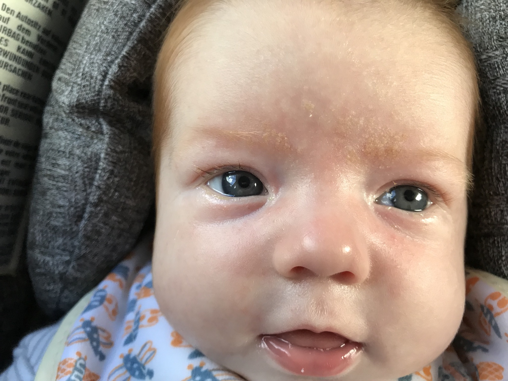Dry Skin On Baby Eyelids Infoupdate Dry Skin On Baby Eyelids Infoupdate