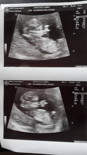 Gender scan at 16 weeks