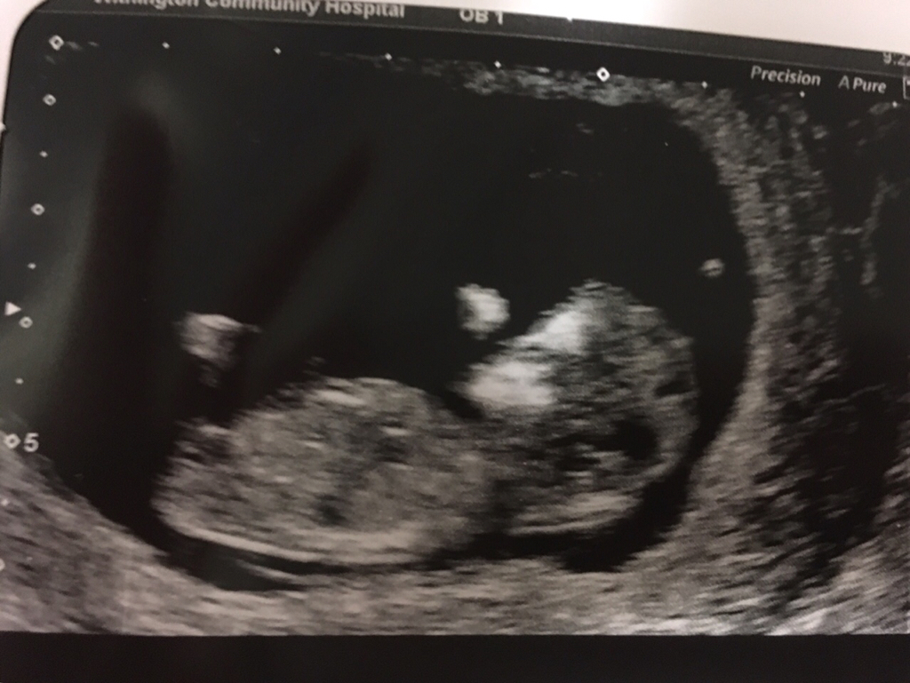 Gender scan at 16 weeks