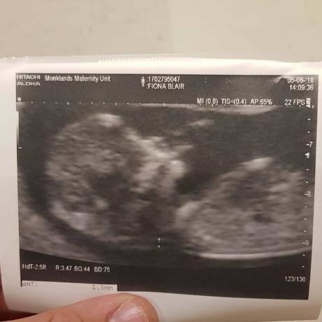 Gender scan at 16 weeks
