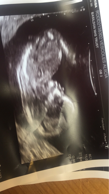 12 week scan gender?
