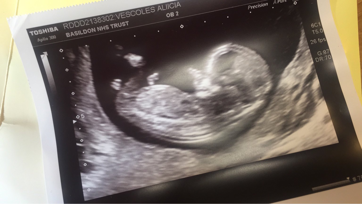 12 week scan gender?