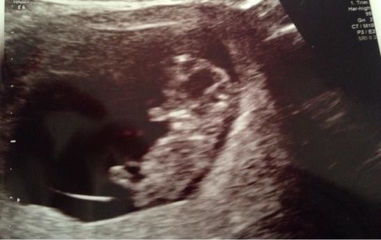 10 Weeks +1 Scan pics