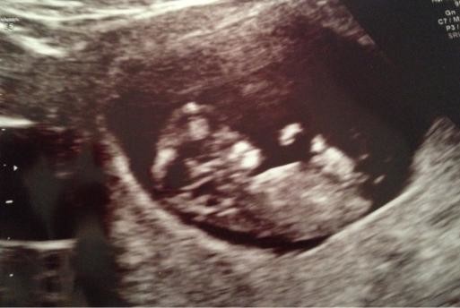 10 Weeks +1 Scan pics