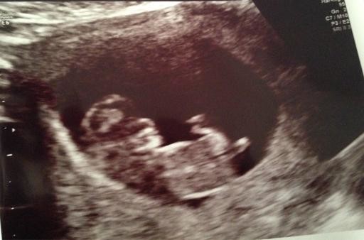 10 Weeks +1 Scan pics