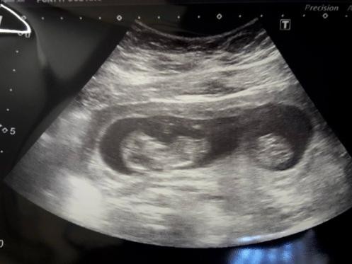 Twins early scan?!