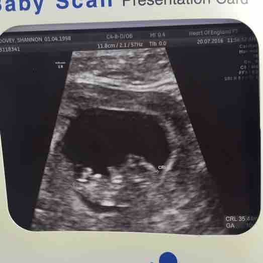 Please post 11 week scans - Page: 2