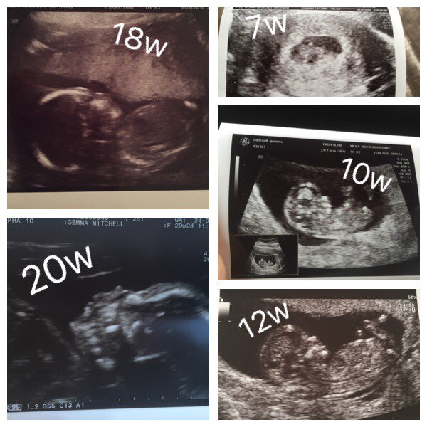 7 week scan pics anyone?