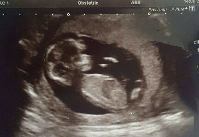 12 week scan tomorrow - Page: 3