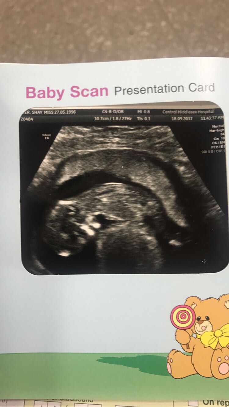 12 week scan