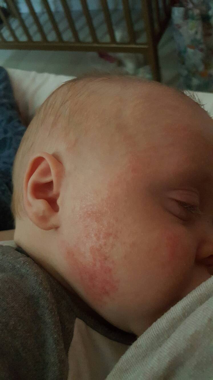 Eczema, weepy sore rash advice