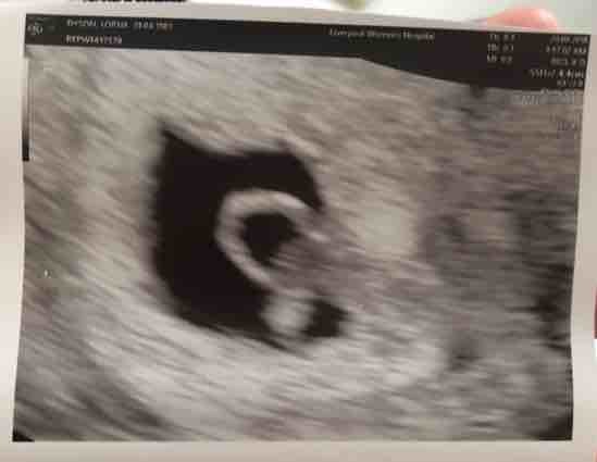 Advice please...Thought I was around 5 wks 6 days, empty fluid sac and ...