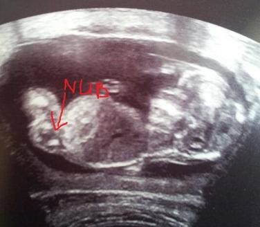 Confirmed GIRL scan nub + bi carb test