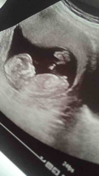 Could anyone have a guess at my identical twin scan??