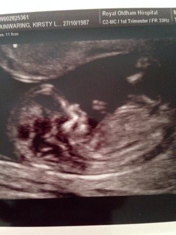 Picture of your 12 week scans?