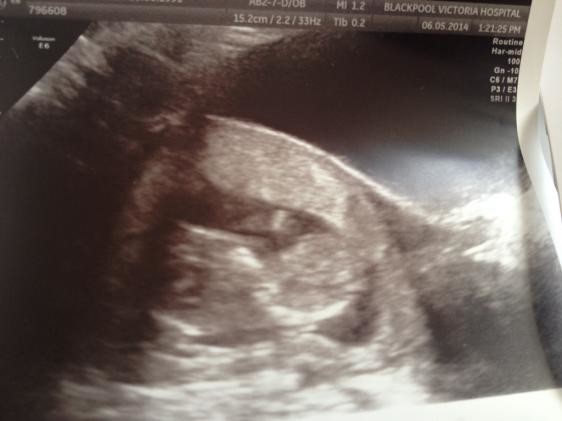 Picture of your 12 week scans?